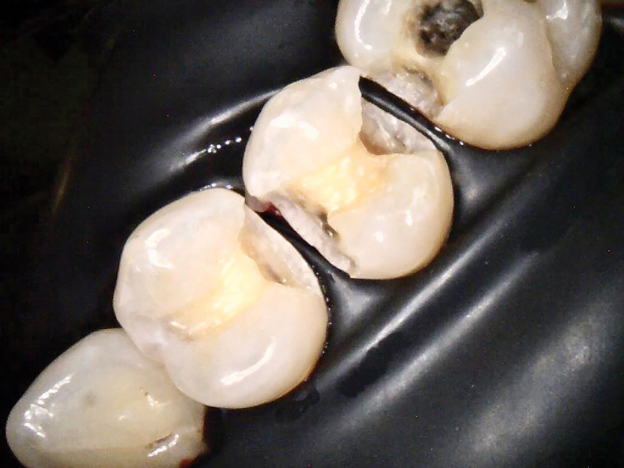 How To Repair Amalgam Restorations With Recurrent Caries